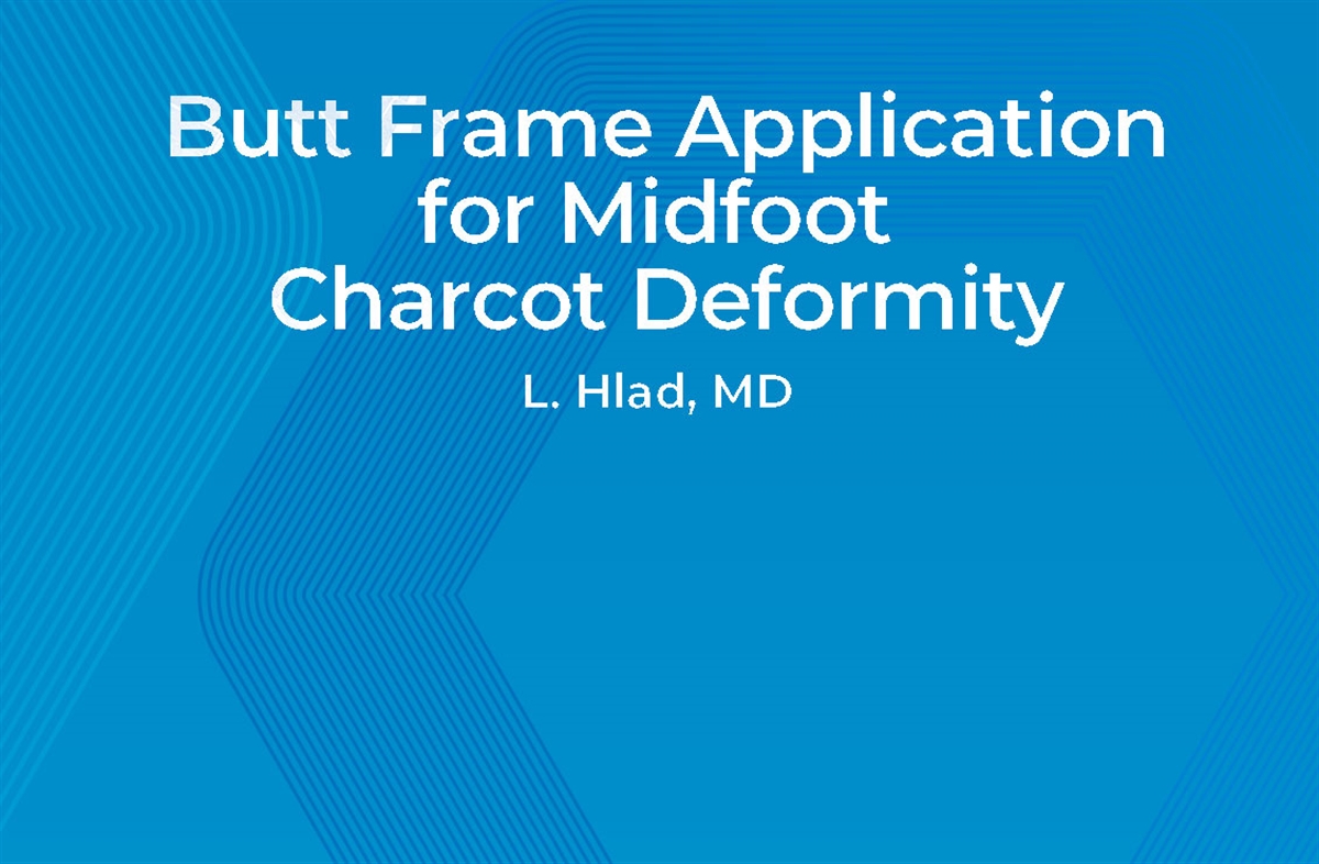 Butt Frame Application for Midfoot Charcot Deformity