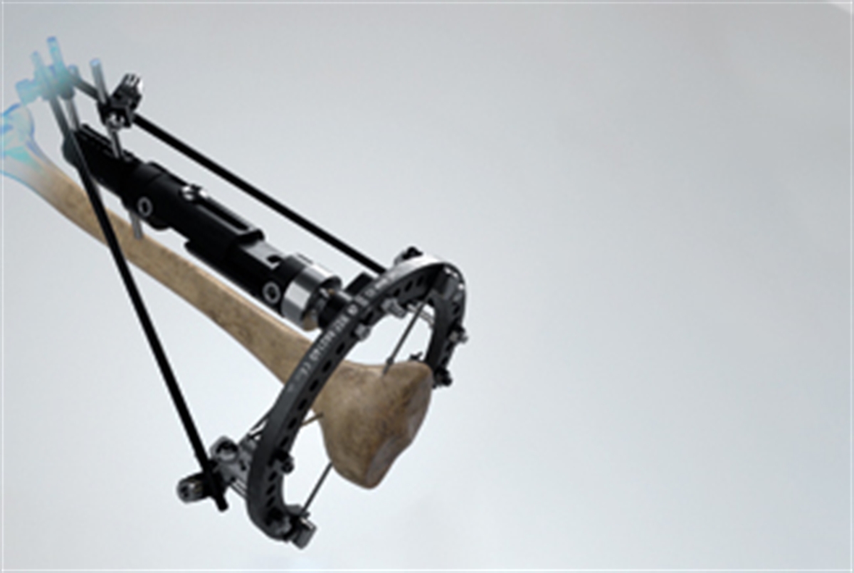 Truelok Evo Procallus Hybrid System