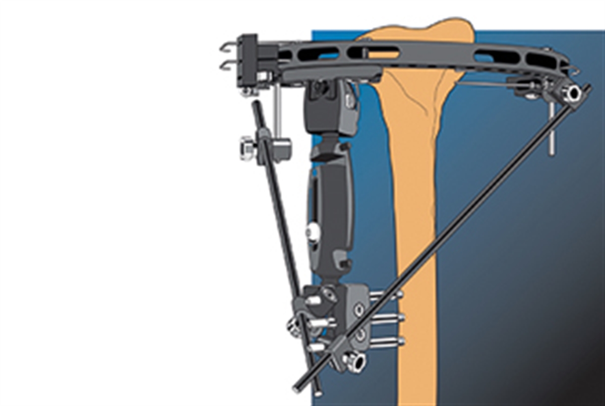 XCaliber Hybrid Fixator