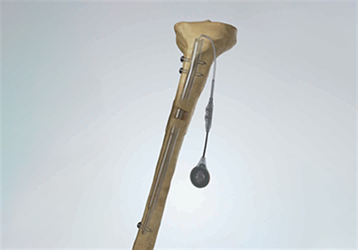 Fitbone TAA Tibia Application