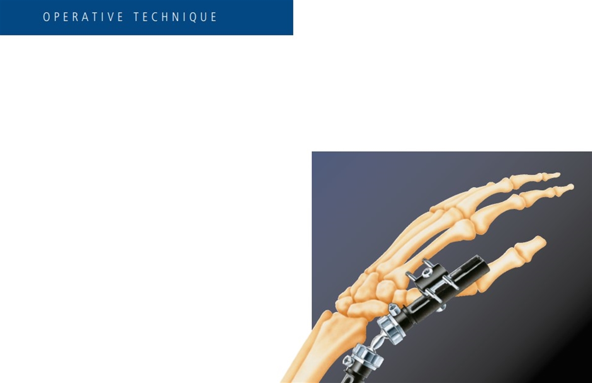 Pennig Dynamic Wrist Fixator