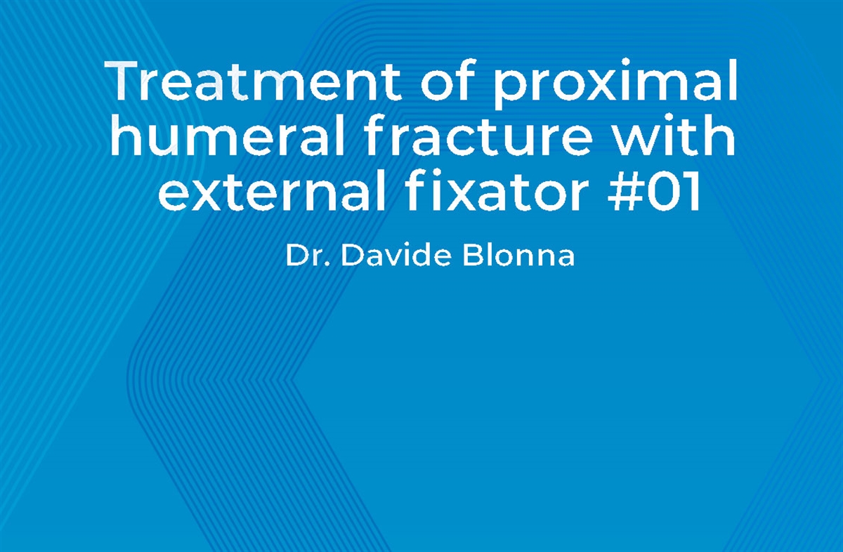 Treatment of proximal humeral fracture with external fixator #01